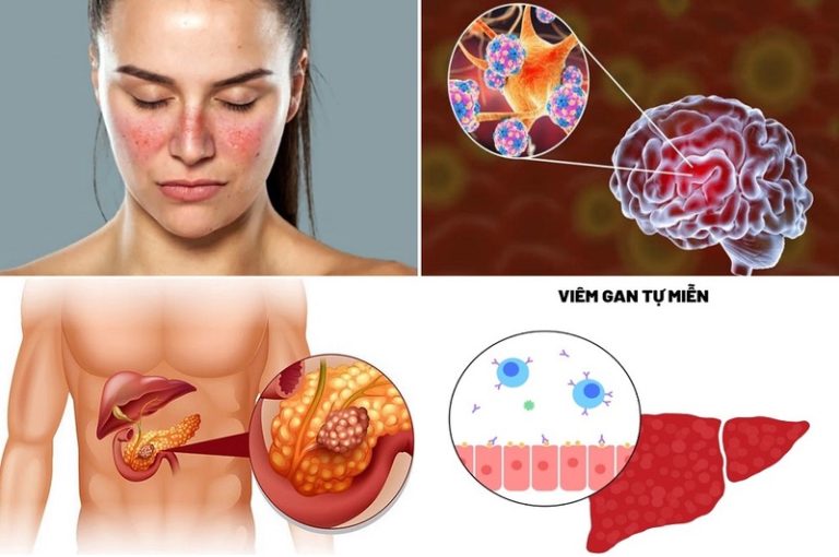 BỆNH TỰ MIỄN - Xét Nghiệm ADN - LAB SG MED